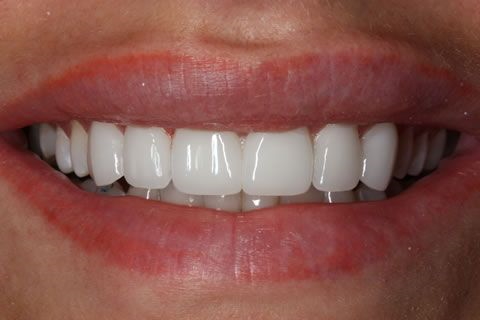 HOW TO HAVE WHITE TEETH? - Blog - Smile Care UK