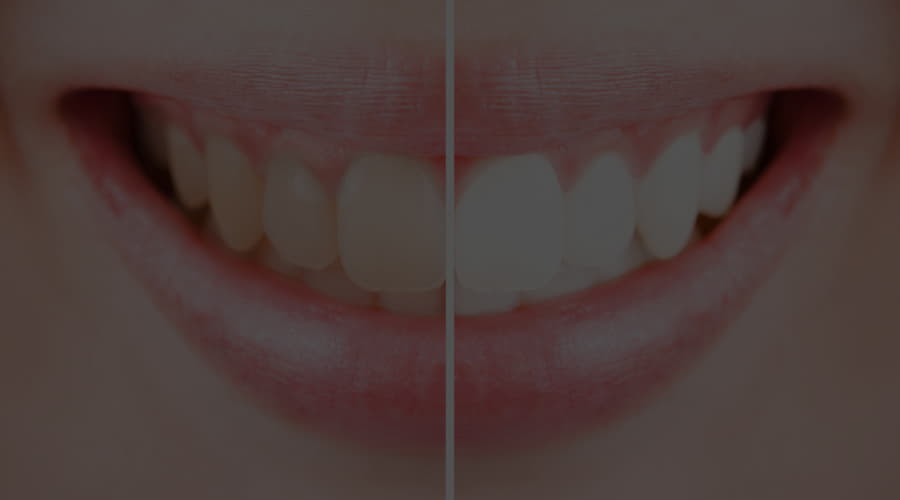 What is Philips Zoom teeth whitening? – Smile Care Plymouth | Smile ...