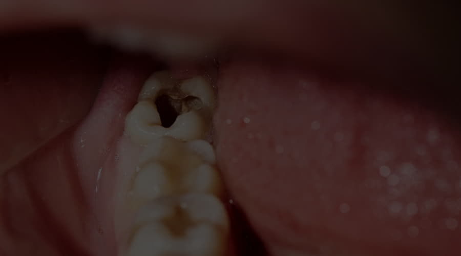 what-is-secondary-caries-smile-care