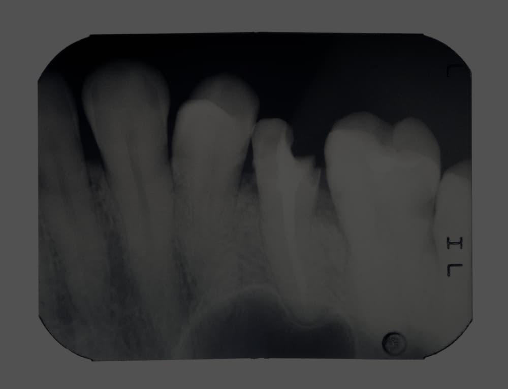 What to do if a tooth breaks | Smile Care Cosmetic Centre